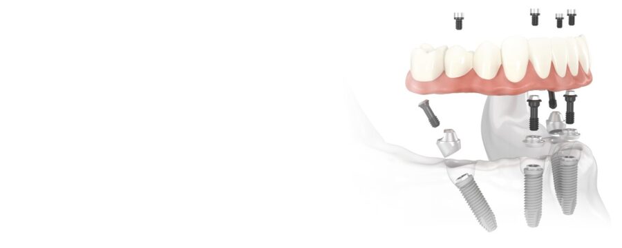 Implant Dentistry | Pro-Art Dental Laboratory | Where Art & Science Meet