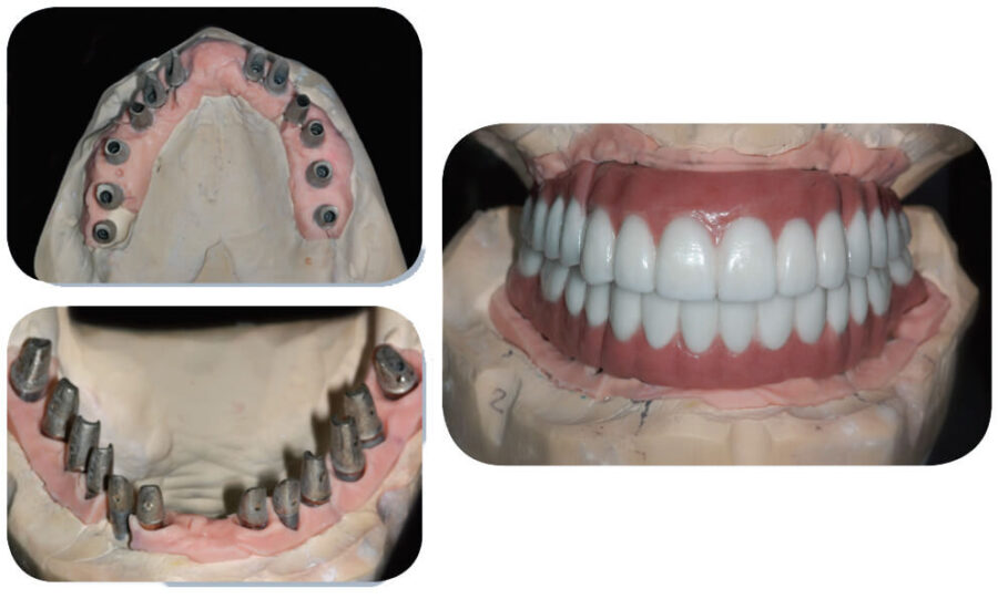Restorations | Pro-Art Dental Laboratory | Where Art & Science Meet