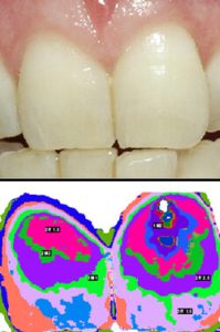 Shade Matching | Pro-Art Dental Laboratory | Where Art & Science Meet
